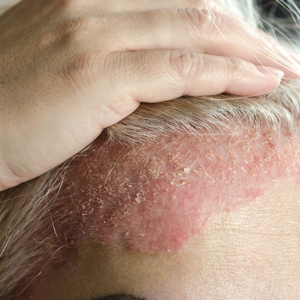 Eczema en el cuero cabelludo: causas y tratamiento eficaz - Phergal ...